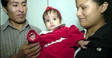 'Mermaid' Baby Faces Risky Surgery - CBS News