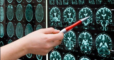 5 Lifestyle Habits That Cut Stroke Risk - CBS News