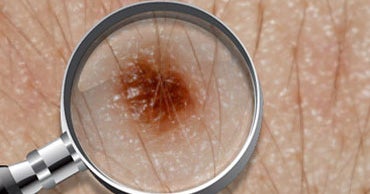 Skin Cancer or Mole? How to Tell Harmless Moles from Deadly ...