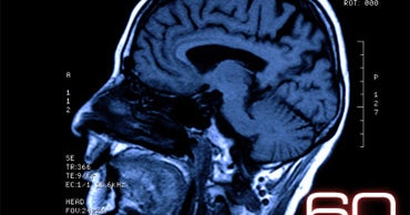 Epilepsy: A Fight For The Cure - CBS News