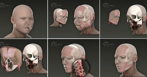 Spanish Hospital Claims 1st Full-Face Transplant - CBS News