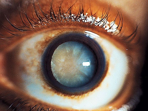 12 scary things your eyes say about your health