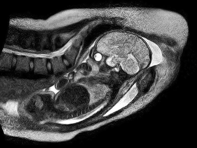 Moment of Birth Captured on MRI