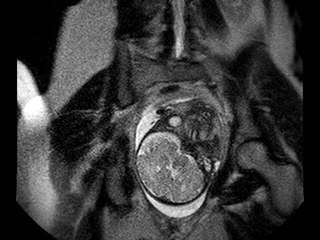 Moment of Birth Captured on MRI