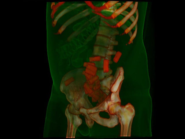 Busted! Drug mules caught on CT scans