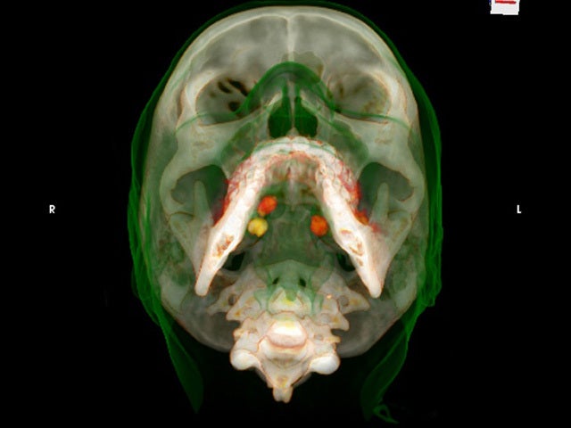 Busted! Drug mules caught on CT scans