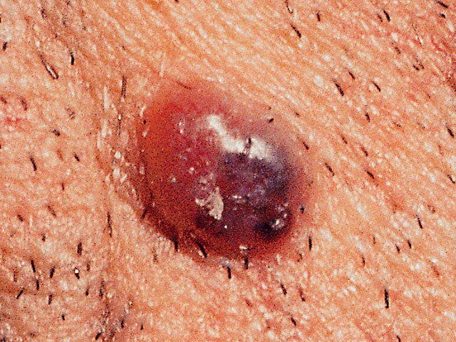 Is it skin cancer? 38 photos that could save your life (PICTURES) - CBS ...