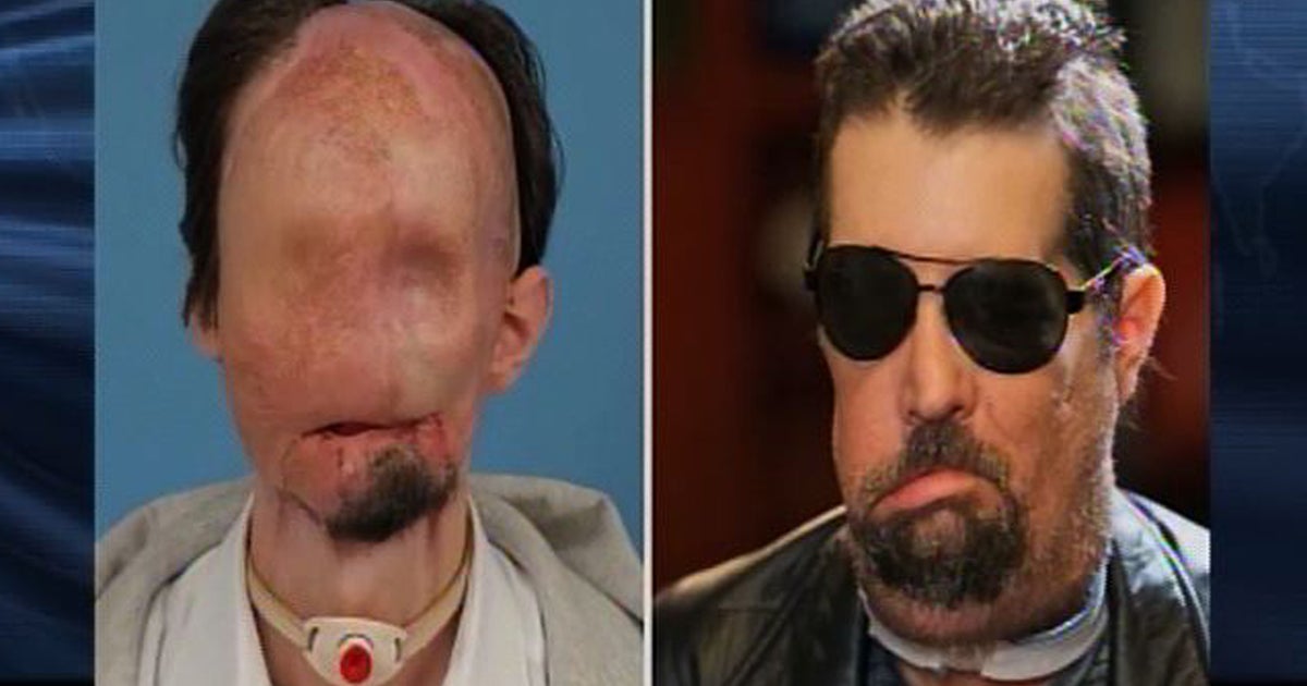 Nation's first face transplant - CBS News