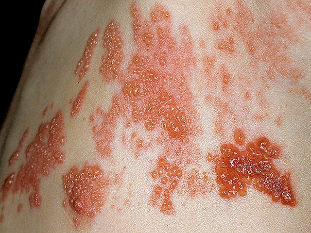 Is it shingles? 7 myths about painful illness (graphic images)