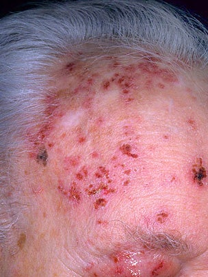 Is it shingles? 7 myths about painful illness (graphic images)