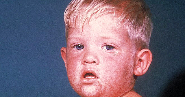 Measles: 7 things parents must know