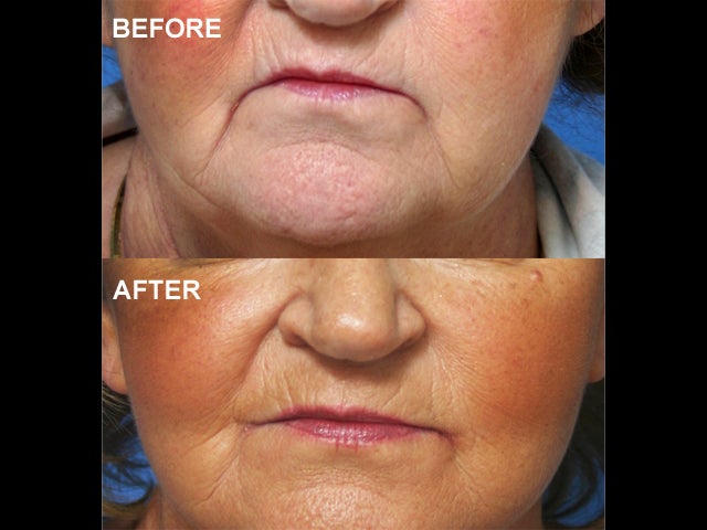 13 bizarre but popular plastic surgery procedures