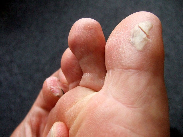 Ouch! 7 nasty foot flaws and how to fix them (GRAPHIC IMAGES)