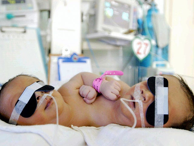 Conjoined twins (WARNING: GRAPHIC IMAGES)