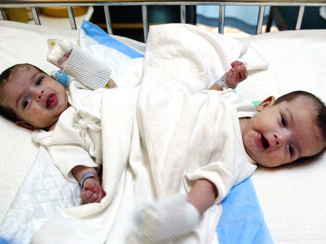 Conjoined twins (WARNING: GRAPHIC IMAGES)