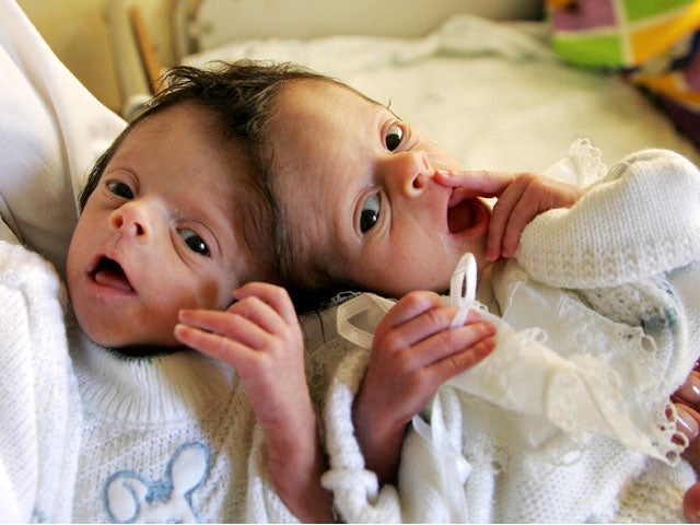 Conjoined twins (WARNING: GRAPHIC IMAGES)