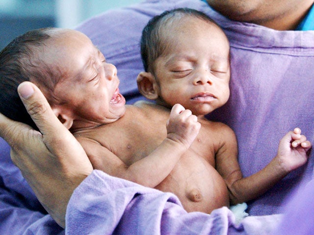 Conjoined twins (WARNING: GRAPHIC IMAGES)