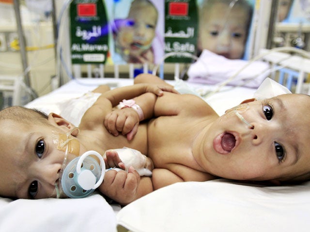 Conjoined twins (WARNING: GRAPHIC IMAGES)