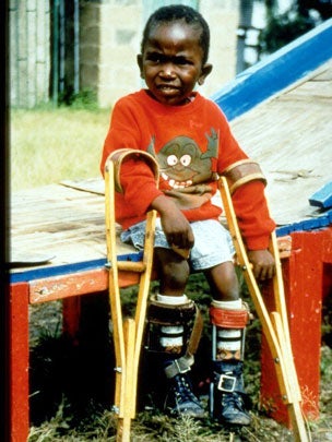 Poliomyelitis: 24 photos of crippling disease