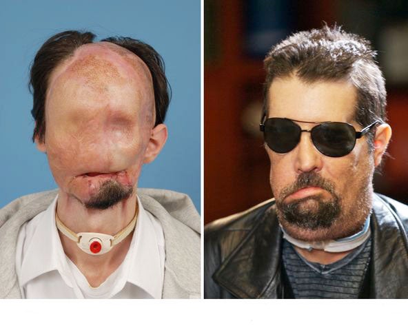 Amazing face transplants (GRAPHIC IMAGES)
