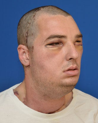 Amazing face transplants (GRAPHIC IMAGES)