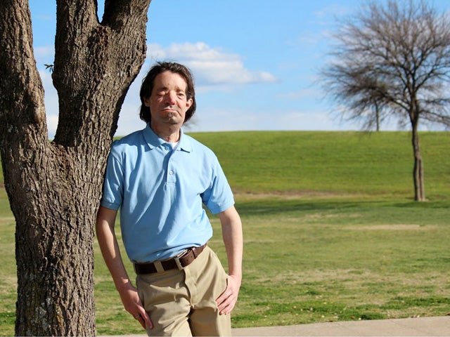 Dallas Wiens' face transplant progress revealed in new images - CBS News