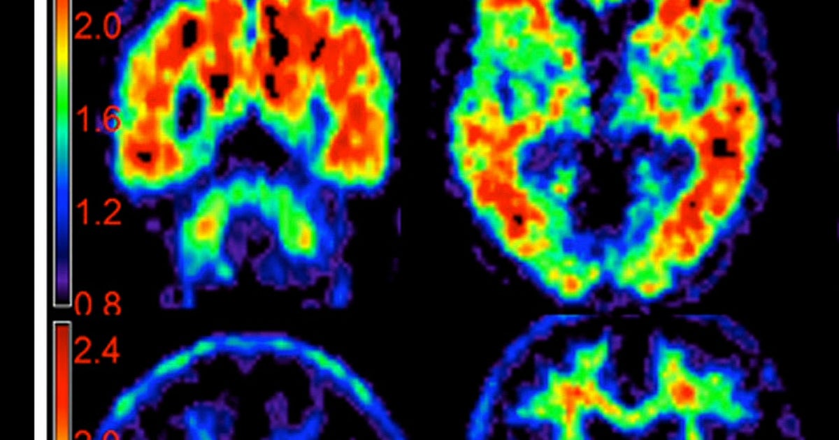 "Brain pacemaker" offers new hope to Alzheimer's patients - CBS News