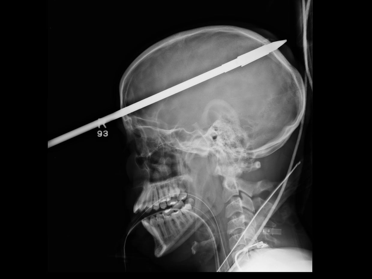 Teen miraculously survives spear through his brain, speaks throughout ...