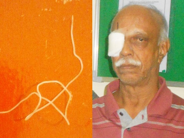 5-inch worm removed from man's eye (GRAPHIC IMAGES)