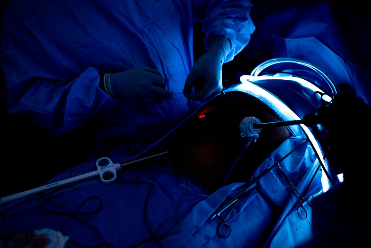 Inside look at kidney transplant (GRAPHIC IMAGES)