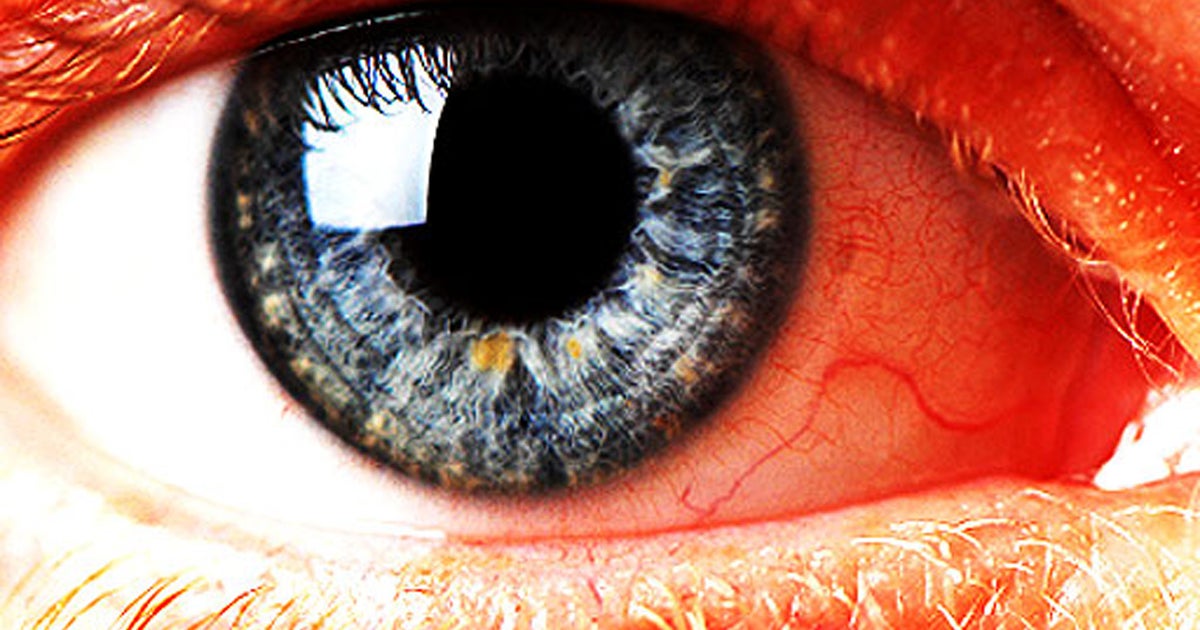 Cholesterol - lowering eye drops may cure leading cause of elderly ...