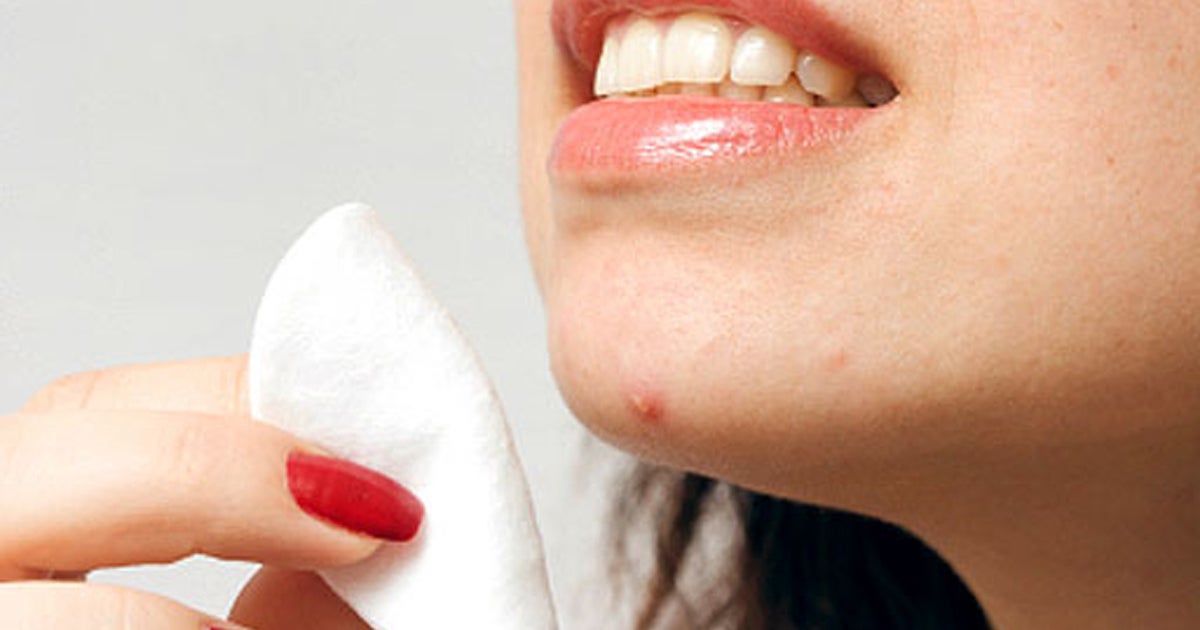 Harmless viruses on skin a potential acne treatment - CBS News