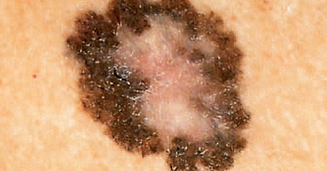 Skin cancer could be hiding where you'd never expect: The sole of your ...