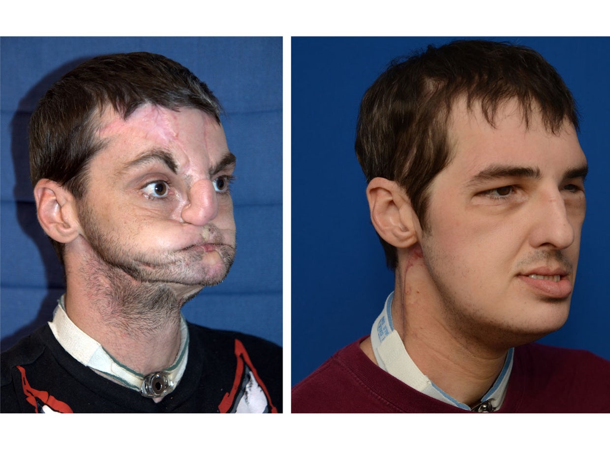 Amazing face transplants (GRAPHIC IMAGES)