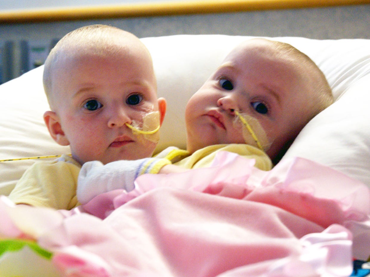 Conjoined twins: Allison and Amelia
