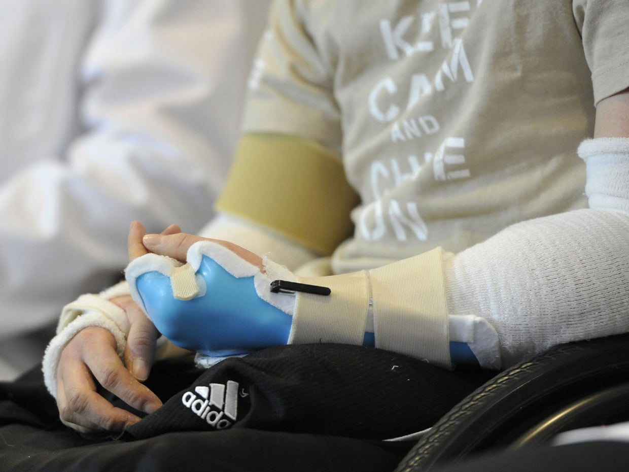Quadruple amputee vet gets double arm transplant