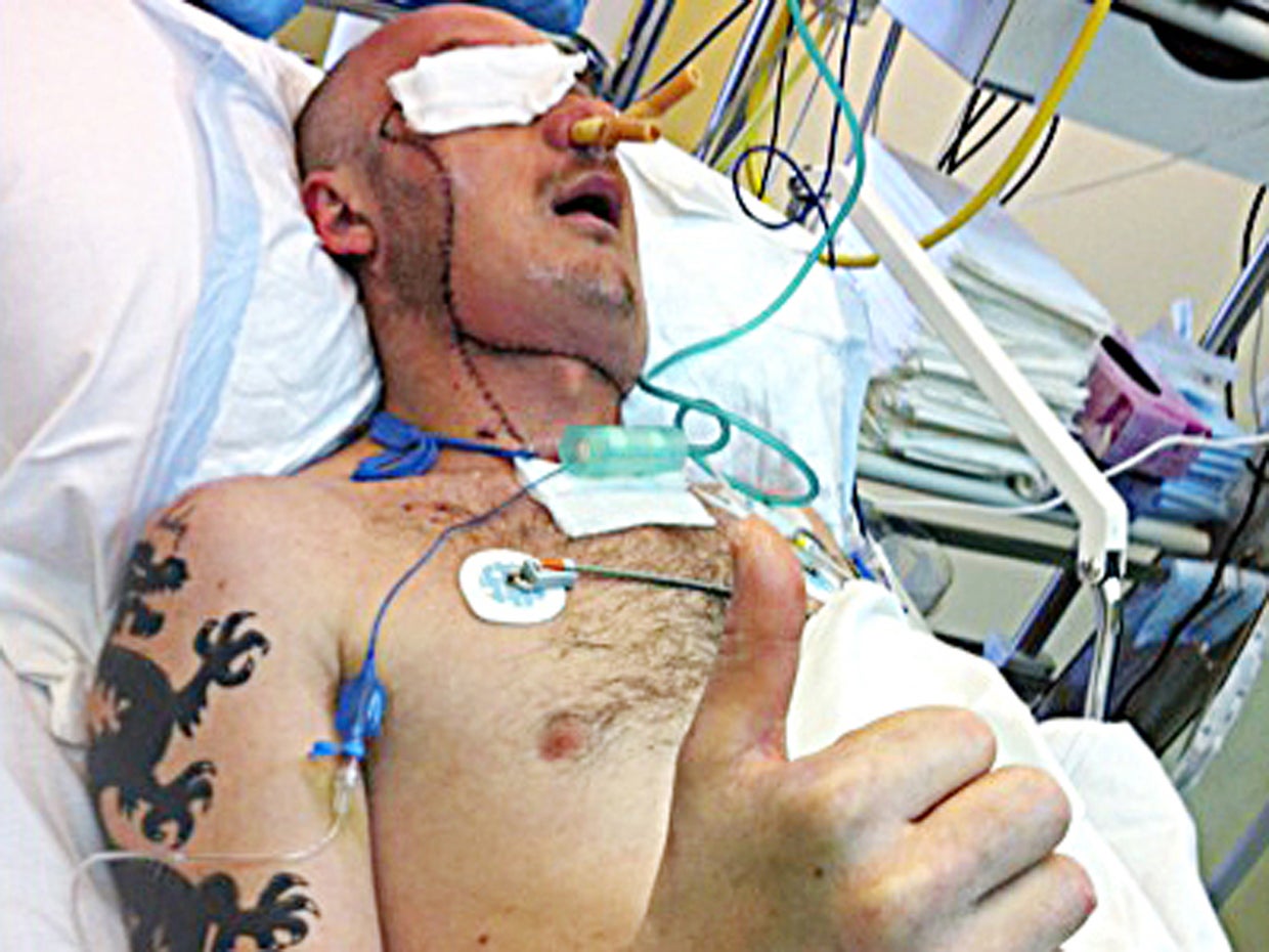 Polish face transplant patient leaves hospital