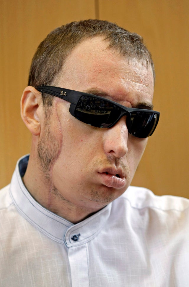 Polish Man Face Transplant
