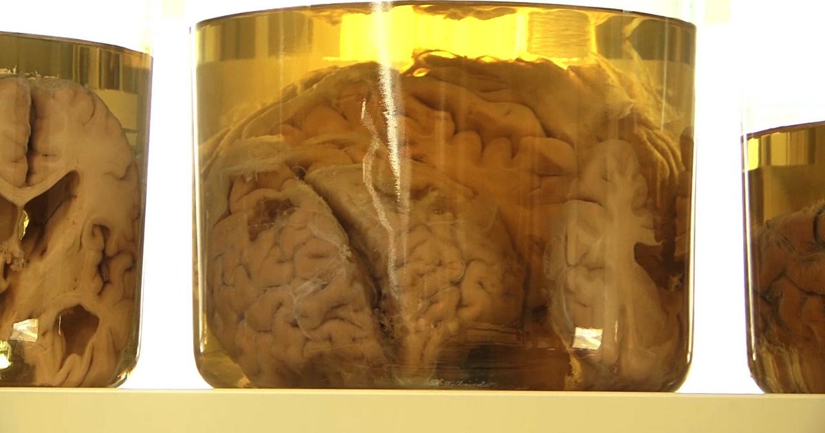 CTE study finds first symptoms in athletes with brain disease - CBS News