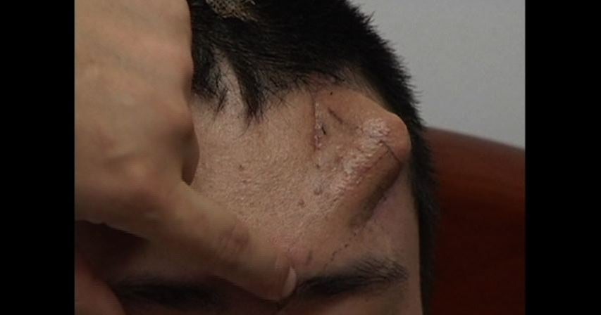 Man's nose grown on forehead ahead of transplant - CBS News