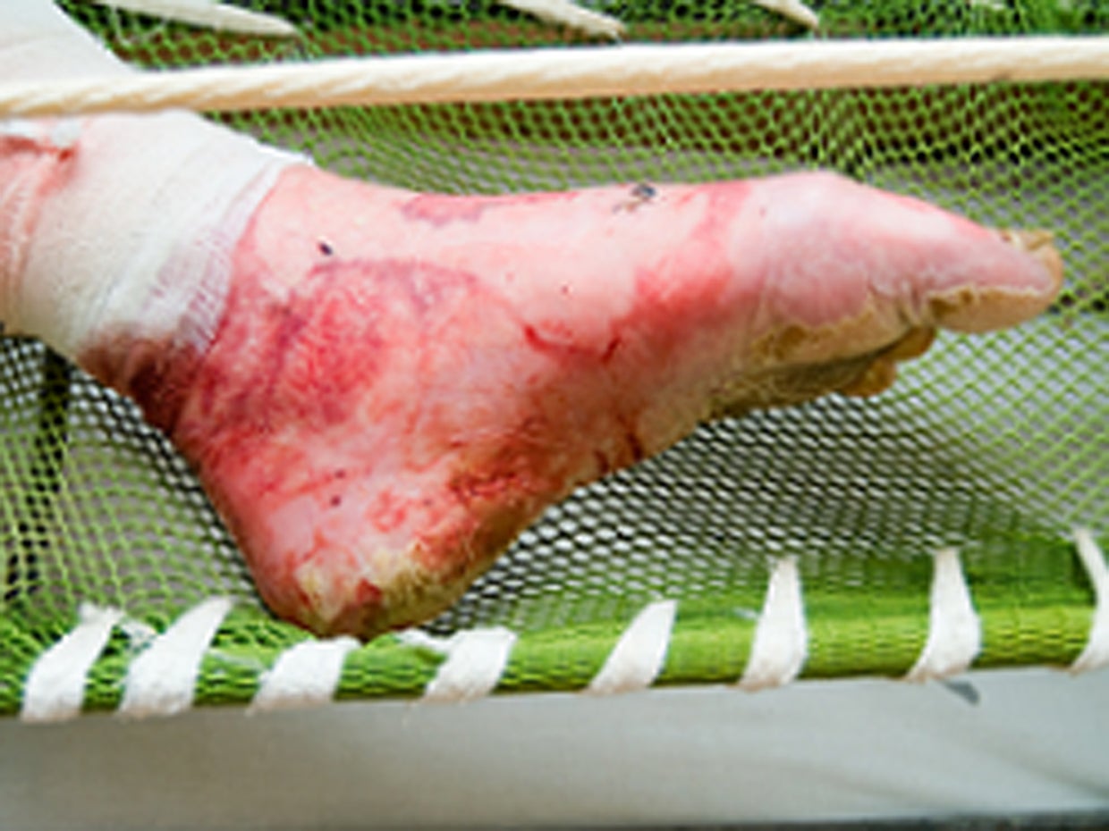 Ariz. poison control center reports first U.S. cases of krokodil use ...