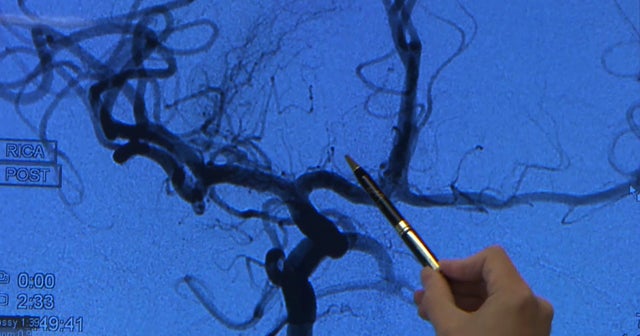 Shingles linked to stroke risk - CBS News