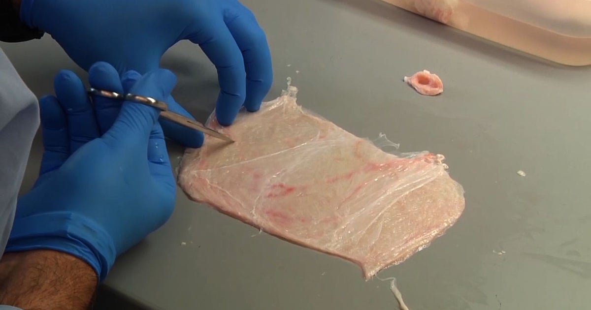 Patients regrow muscles with pig bladder tissue - CBS News