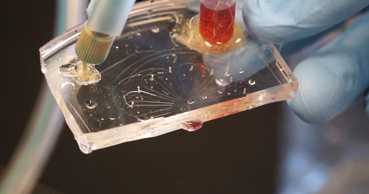 How 3D printing could revolutionize burn treatment - CBS News