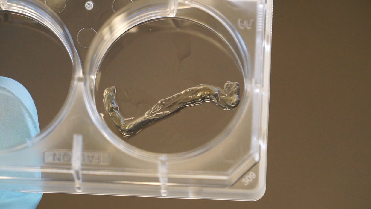 How 3D printing could revolutionize burn treatment - CBS News