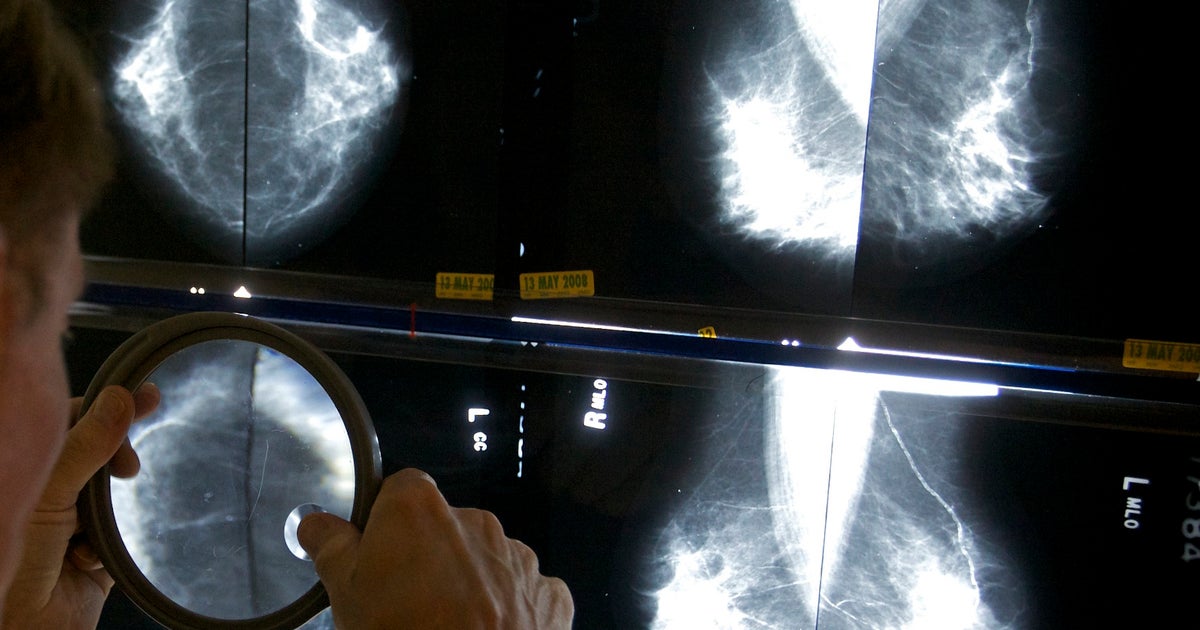 The high cost of "false positive" mammograms for breast cancer - CBS News