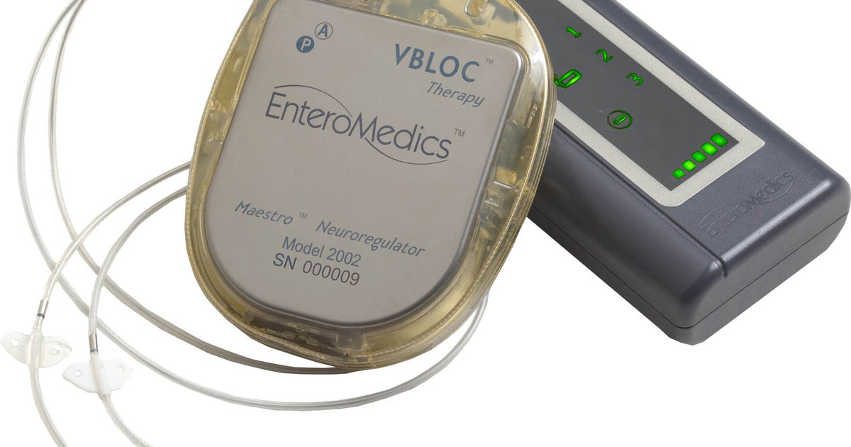 FDA approves new kind of device to treat obesity - CBS News
