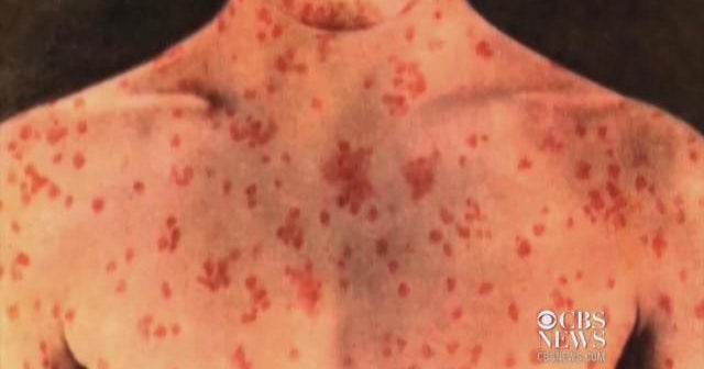Arizona monitoring 1,000 people for measles - CBS News