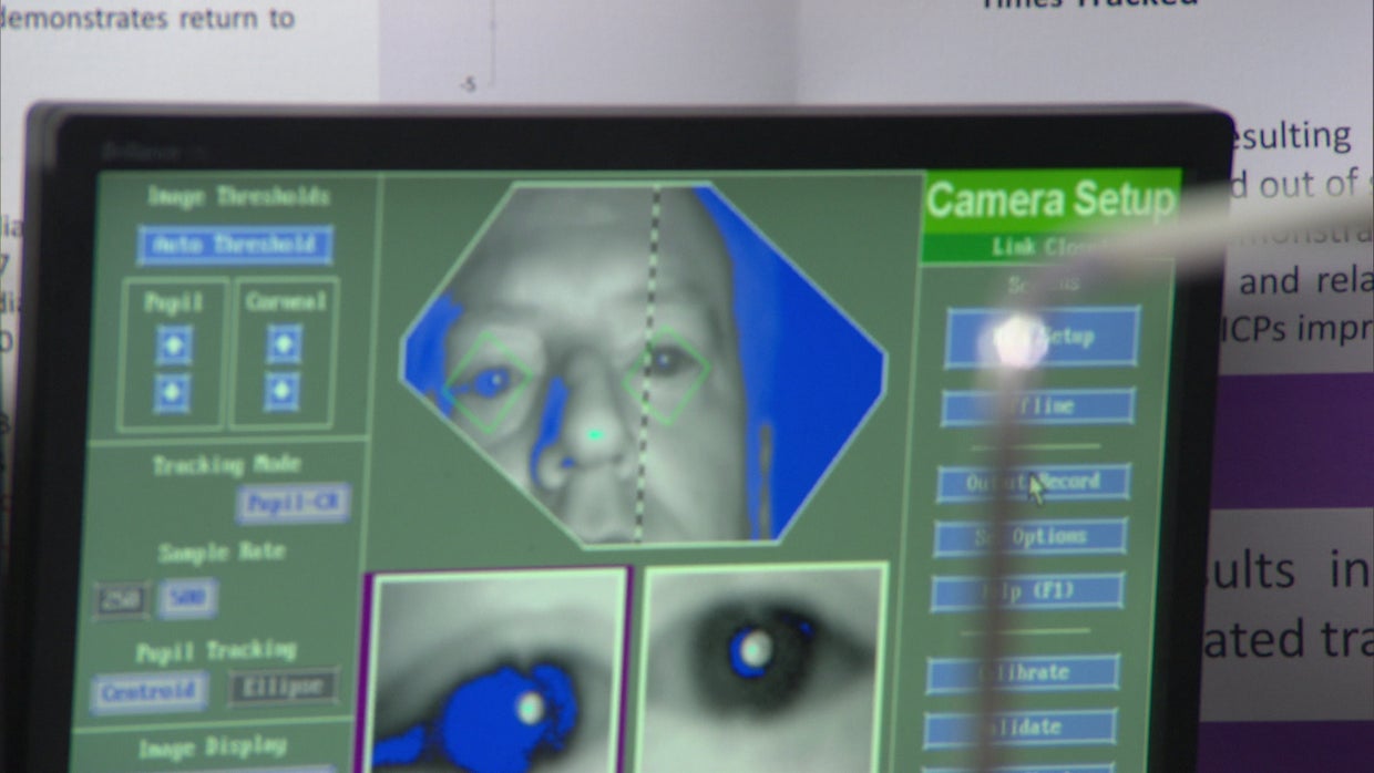 Wile E. Coyote inspires new way to diagnose concussions - CBS News