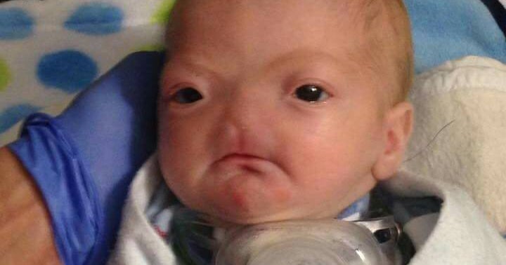 Mom seeks help for baby born without a nose - CBS News